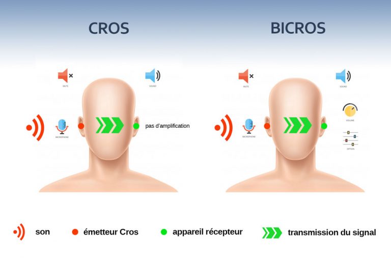 Appareil auditif Cros : pourquoi dois-je choisir un Cros